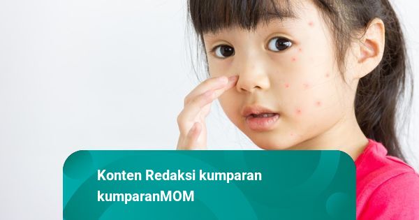 3 Tanda Balita Alergi Protein Susu Sapi | kumparan.com