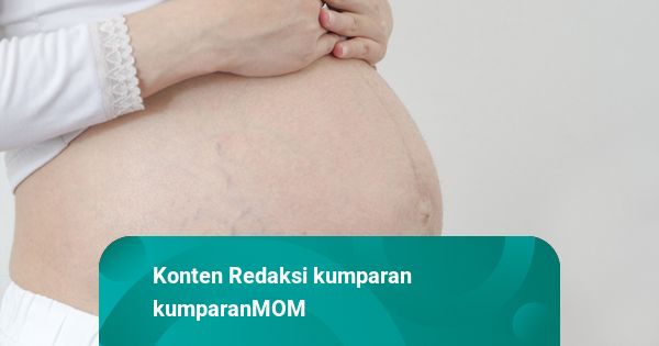 Penyebab dan Cara Atasi Stretch Mark saat Hamil | kumparan.com