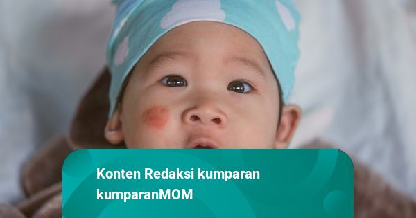 7 Jenis Ruam pada Bayi dan Cara Mengatasinya | kumparan.com