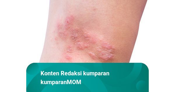 7 Cara Atasi Eksim pada Anak | kumparan.com