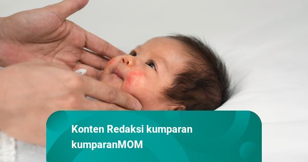 Ruam Susu pada Bayi ASI, Apa Bedanya dengan Alergi? | kumparan.com