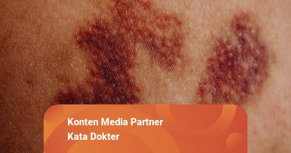 Bercak Coklat di Kulit seperti Panu: Gejala, Penyebab, dan Cara ...