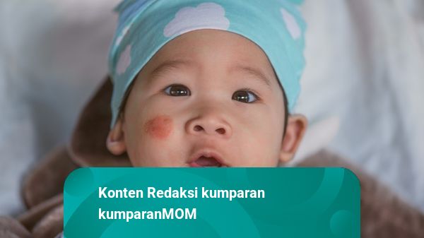 7 Jenis Ruam pada Bayi dan Cara Mengatasinya | kumparan.com