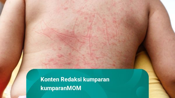 Cara Bedakan Bintik Merah Demam Berdarah dengan Ruam Biasa pada Kulit ...