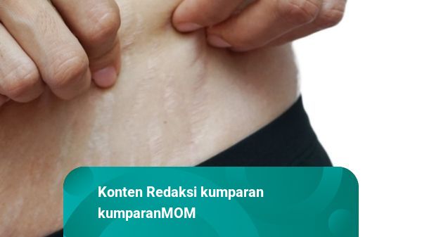 Apa Bedanya Stretch Mark dengan Selulit? | kumparan.com