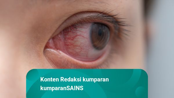 Wanita Ini Terancam Buta Gara-gara Tato Warna Ungu dan Biru di Bola ...