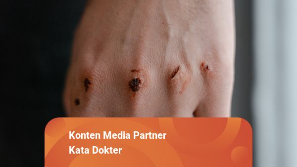 5 Cara Mengobati Koreng yang Tak Kunjung Sembuh Beserta Penyebabnya ...