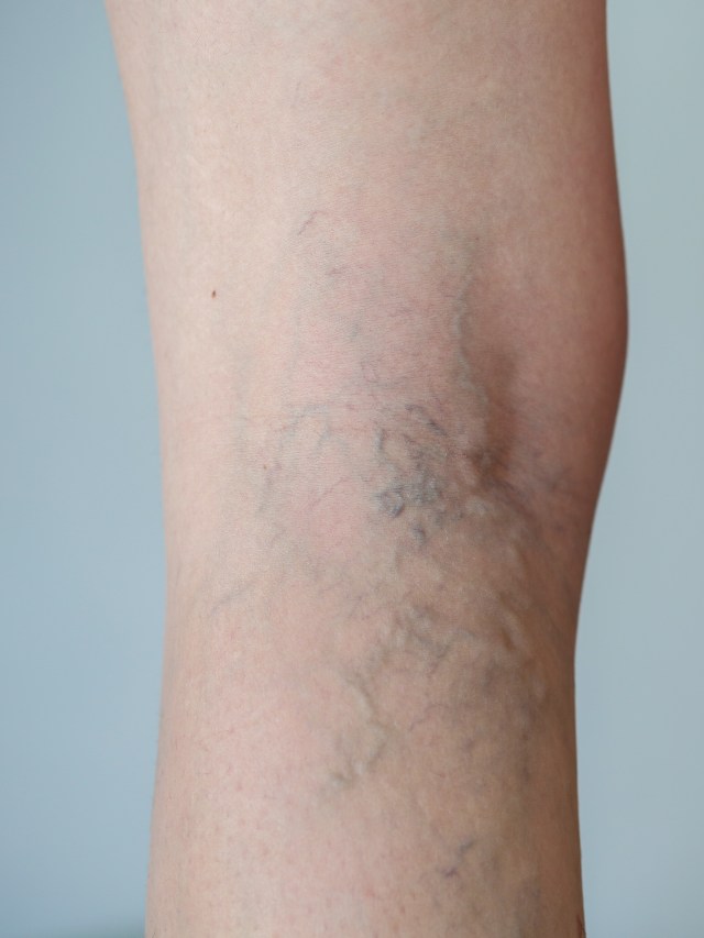 Yang Perlu Dipahami Soal Varises saat Hamil | kumparan.com