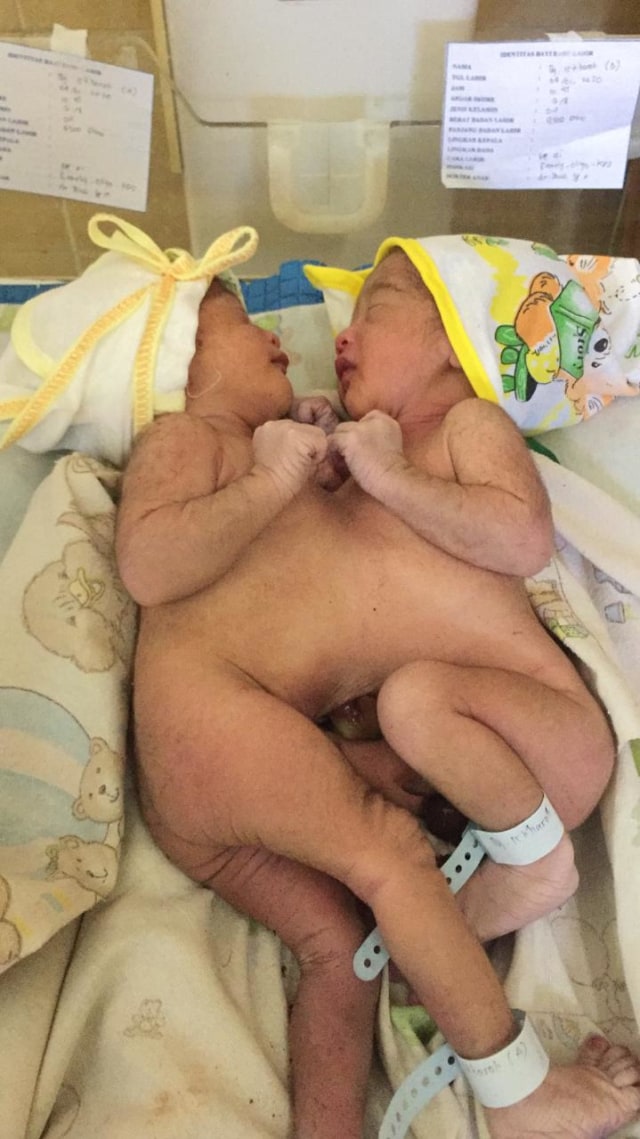 Bayi Lahir Kembar Siam Dempet Dada di Kobar Butuh Donasi | kumparan.com