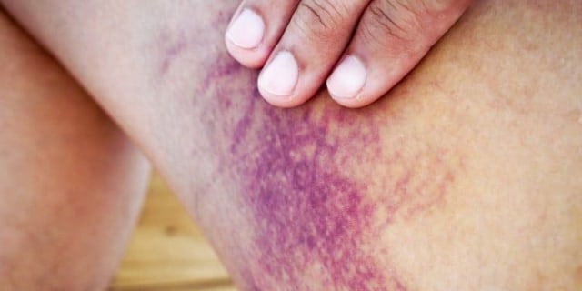 Munculnya Lebam pada Badan Secara Mendadak, Benarkah karena Dijilat ...