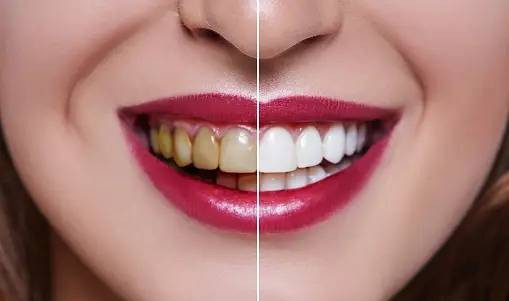 Mengenali Penyebab Gigi Kuning dan Cara Mengatasinya | kumparan.com