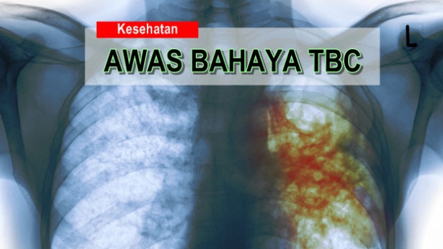 Bahaya TBC Dan Info Pengobatannya | kumparan.com