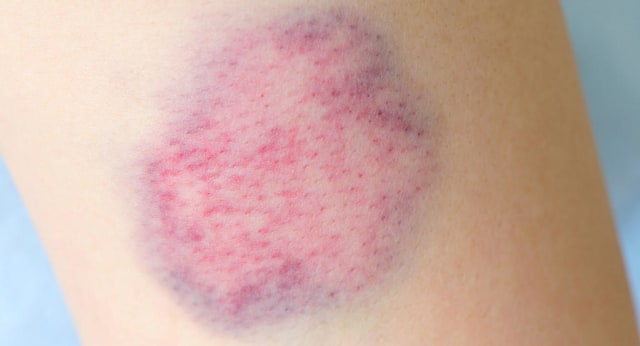 Mengapa Kulit Bisa Memar? | kumparan.com