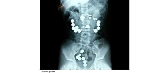 Mengintip 5 Hasil Rontgen Pasien Tertanam Benda Asing dalam Tubuhnya ...