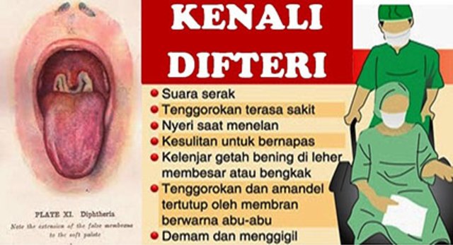 STIKESMUS Tanggapi Serius Wabah Difteri di Indonesia | kumparan.com