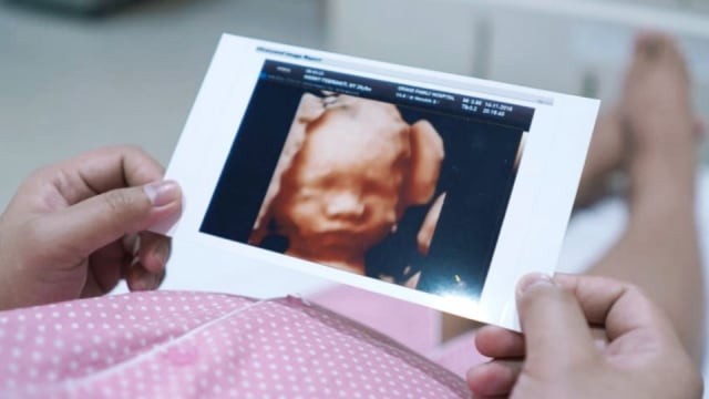 Lahiran Caesar Karena Air Ketuban Kering | kumparan.com