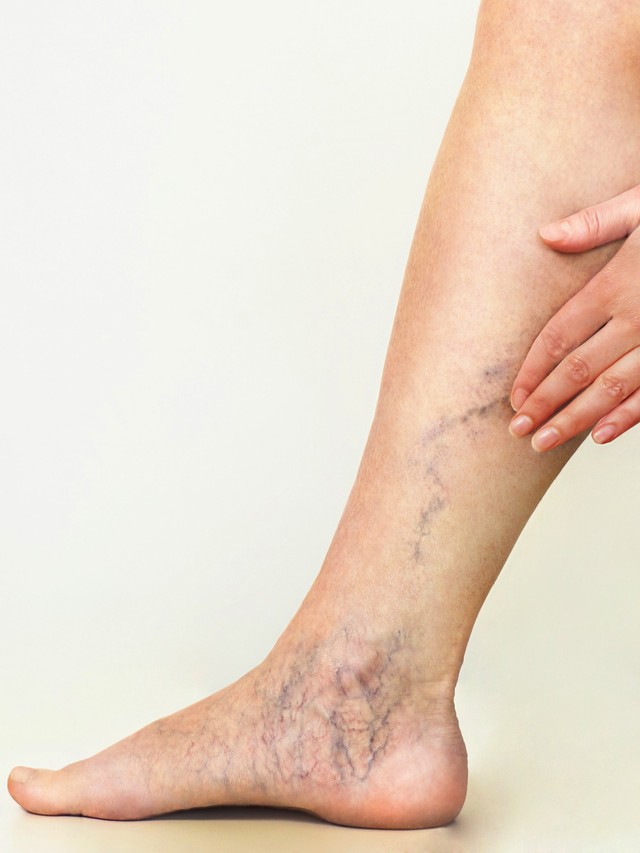 Cara Cegah Varises Setelah Melahirkan | kumparan.com