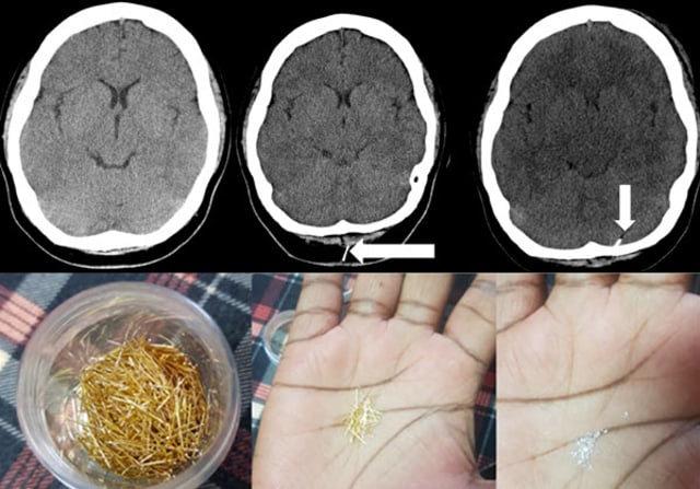 Apa Itu Susuk? Ini Penjelasannya Secara Medis dan Magis | kumparan.com