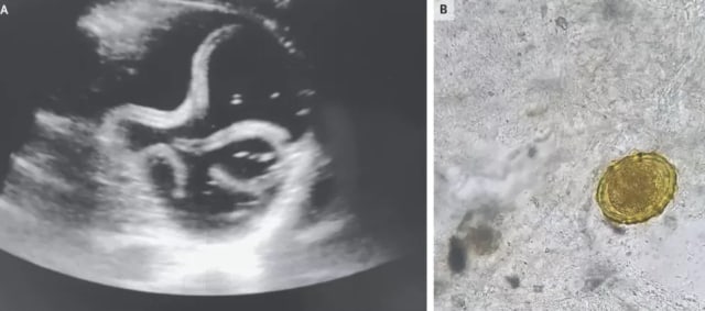 Hasil USG Ungkap Keberadaan Cacing yang Hidup di Perut Pria Ini ...