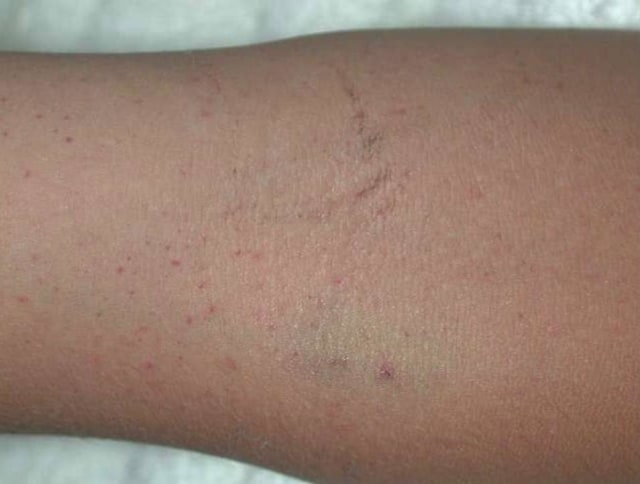 Musim Demam Berdarah, Ini Beda Demam DBD dan COVID-19 | kumparan.com