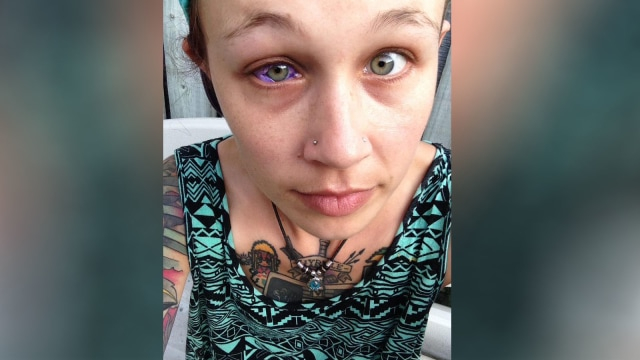 Bikin Tato di Bola Mata, Model Ini Alami Infeksi Hingga Nyaris Buta ...