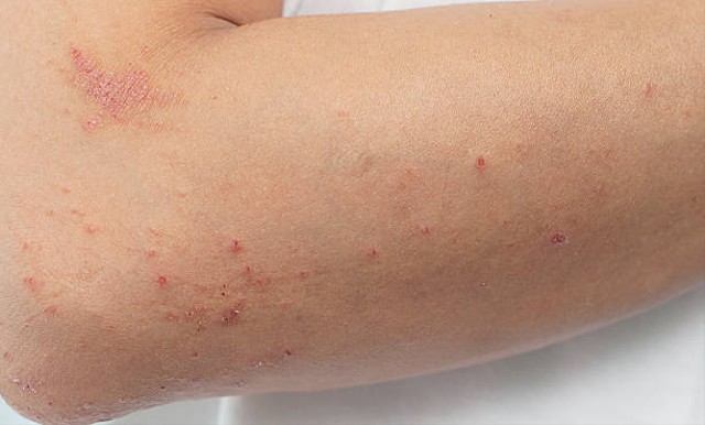 Cacar Ular: Gejala, Diagnosis, hingga Pengobatannya | kumparan.com