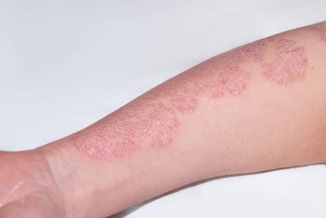 Cacar Ular: Gejala, Diagnosis, hingga Pengobatannya | kumparan.com