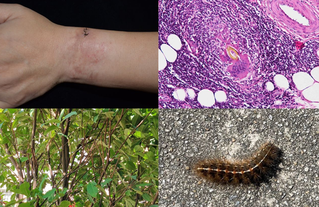 Dikira Eksim Berbulan-bulan, Ternyata Ada ‘Bulu Ulat’ di Bawah Kulit ...