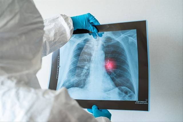 Mengenal Jenis-Jenis Edema Berdasarkan Lokasi dan Penyebabnya ...