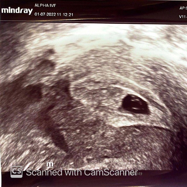 Penyebab Keguguran di Usia Kehamilan 7 Minggu Seperti Annisa Pohan ...