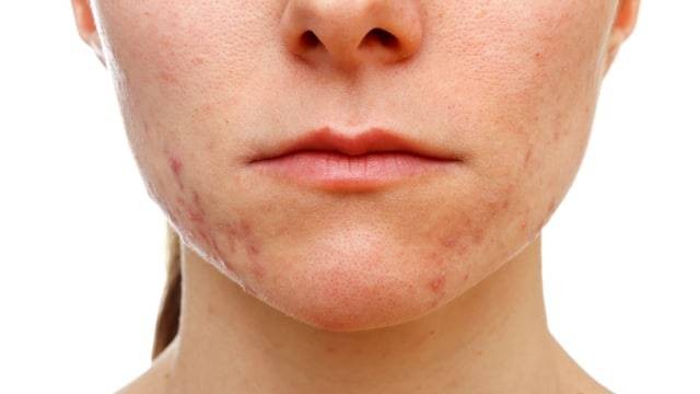Rubella: Ciri, Penyebab, dan Cara Mencegahnya | kumparan.com