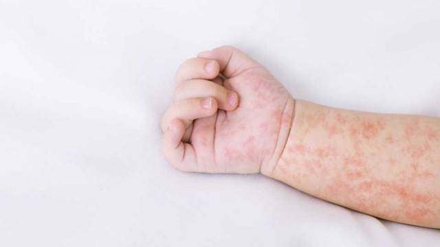 Memahami Gejala Rubella pada Anak-Anak dan Orang Dewasa | kumparan.com