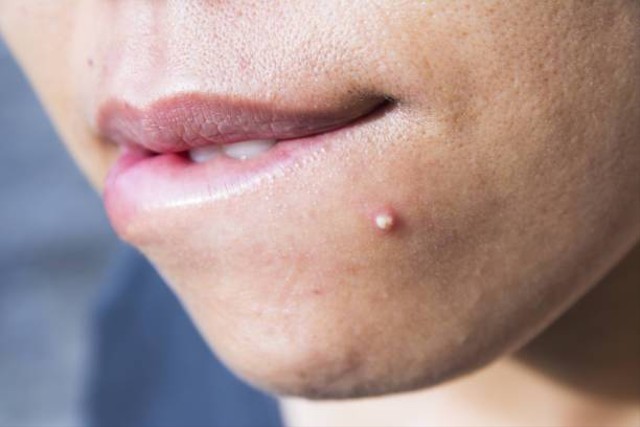 Jenis Jerawat yang Sering Muncul pada Wajah | kumparan.com