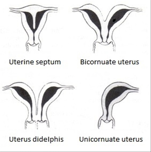 Mengenal Bicornuate Uterus, Kelainan Rahim Berbentuk Hati | kumparan.com