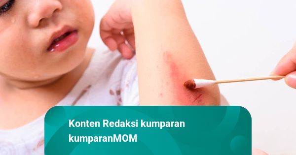 Penanganan Luka Anak Tanpa Perih, Ini Hal yang Perlu Ibu Perhatikan ...