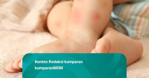 5 Salep Gatal untuk Bayi yang Aman untuk Kulit Sensitif | kumparan.com