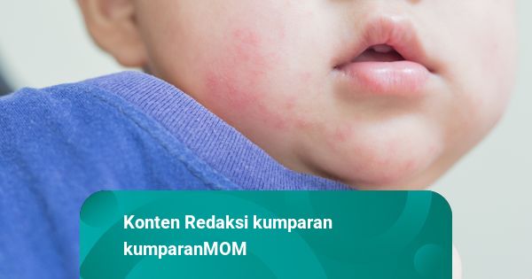Bisakah Bayi Alergi Salmon? | kumparan.com