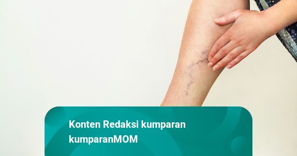Tips Meminimalisir Munculnya Varises Selama Masa Kehamilan | kumparan.com