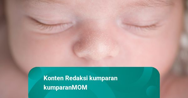 Mengenal Penyebab Muncul Bercak Putih di Wajah Anak | kumparan.com