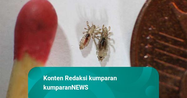 5 Fakta Unik Soal Kutu Rambut | kumparan.com