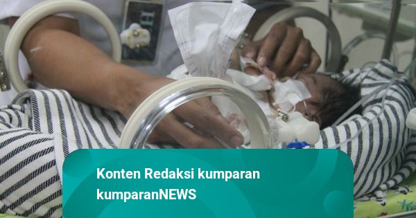 Dokter Sebut Bayi Terlahir 4 Kaki dan Tangan di Bali Kembar Parasit ...