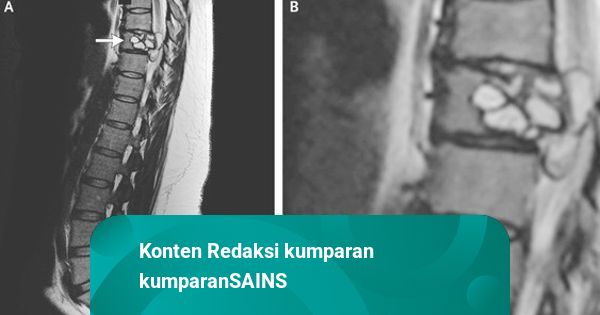Parasit di Tulang Belakang Bikin Kaki Seorang Wanita seperti Tersetrum ...