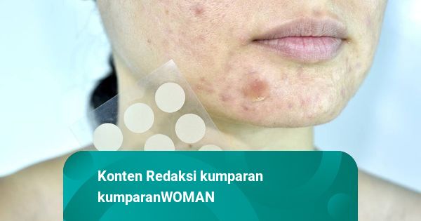 Pakai Acne Patch untuk Hilangkan Jerawat, Efektif Nggak Sih? Ini Kata ...