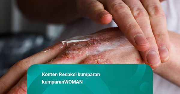 Cara Cegah dan Atasi Kulit Tangan Kering dan Terkelupas Menurut ...