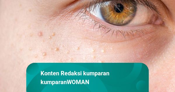 5 Bahan Alami untuk Hilangkan Milia di Wajah, Salah Satunya Air Mawar ...