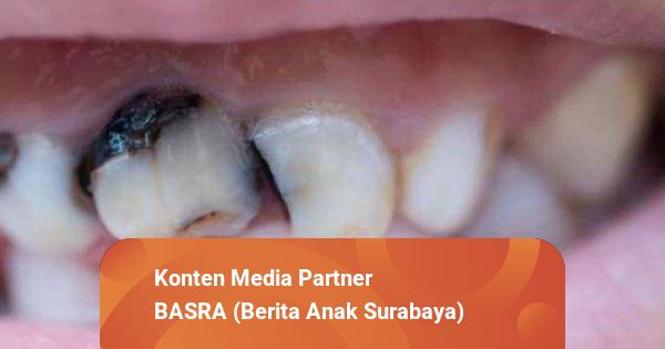 Penyebab Gigi Anak Hitam dan Cara Penanganannya | kumparan.com