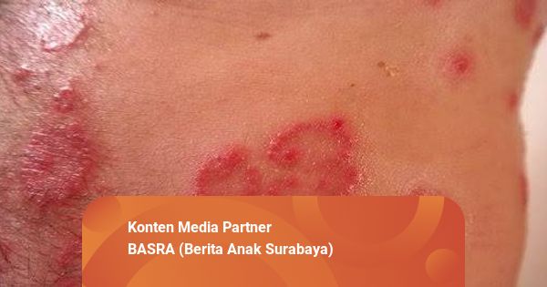 Surabaya Dinyatakan Bebas Kasus Frambusia, Penyakit Apa Itu? | kumparan.com