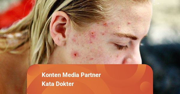 7 Cara Menghilangkan Bopeng di Wajah yang Efektif | kumparan.com