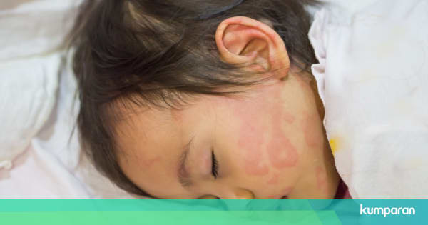 Cara Atasi Kaligata pada Anak - kumparan.com