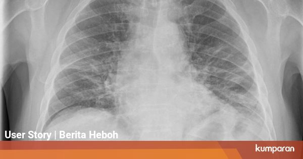 Melihat Foto Rontgen Paru-paru Pasien Positif Corona - kumparan.com